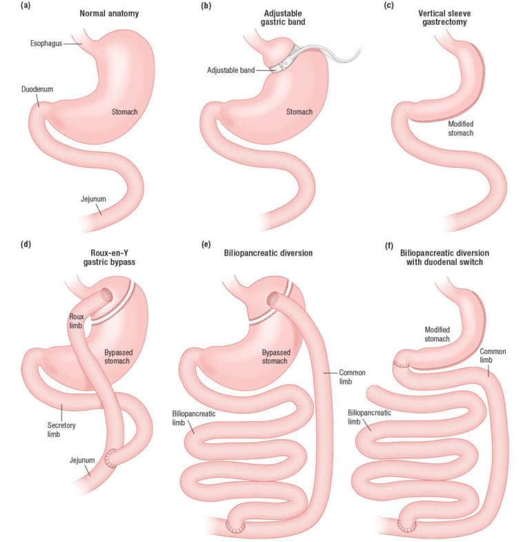 Gastric bypass procedures | Battista Illustration